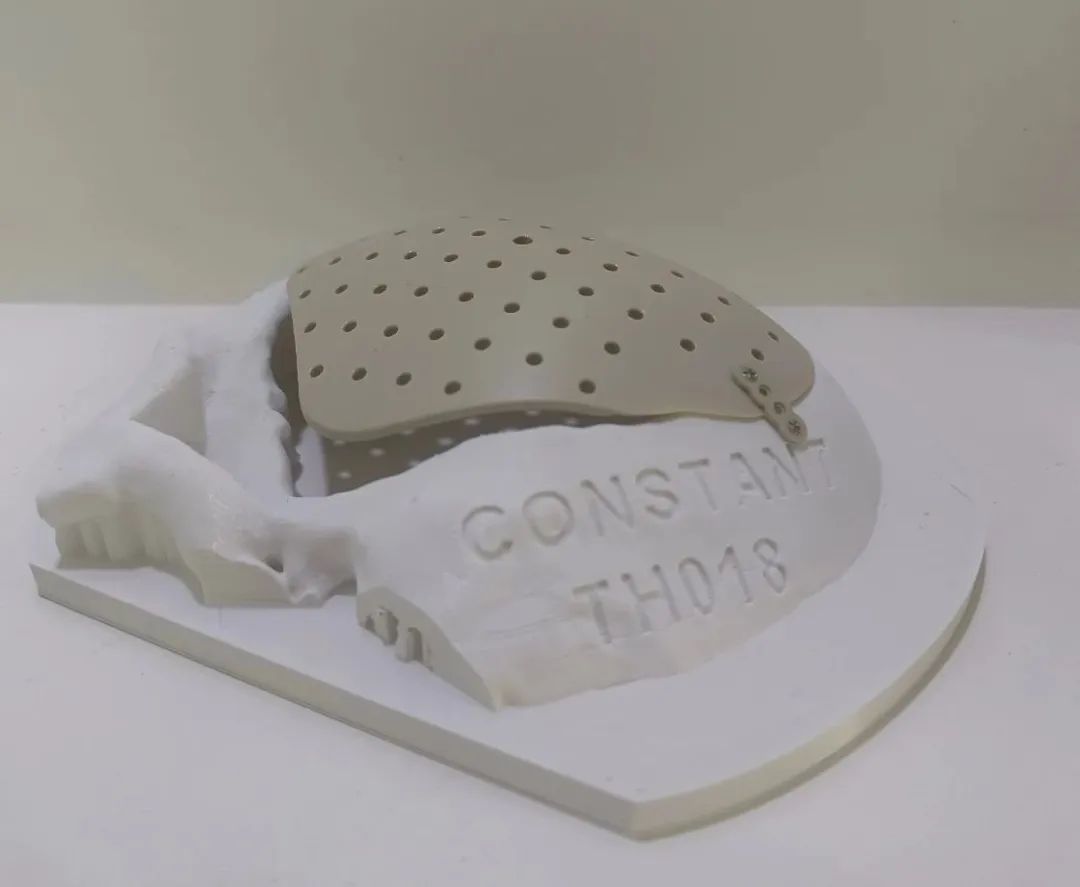 Progress In Material Selection For Cranioplasty - Junsun Peek
