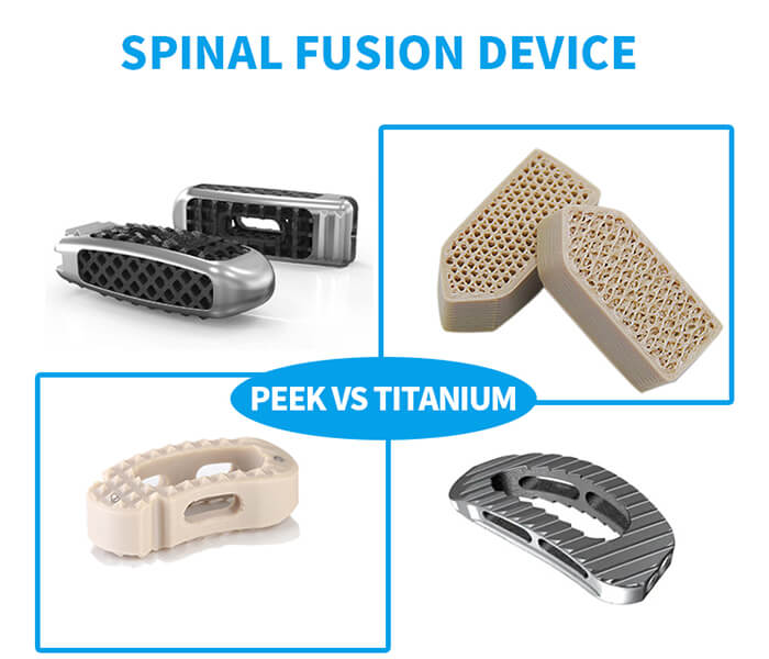 How Are Fusion Cages Used in Human Bones